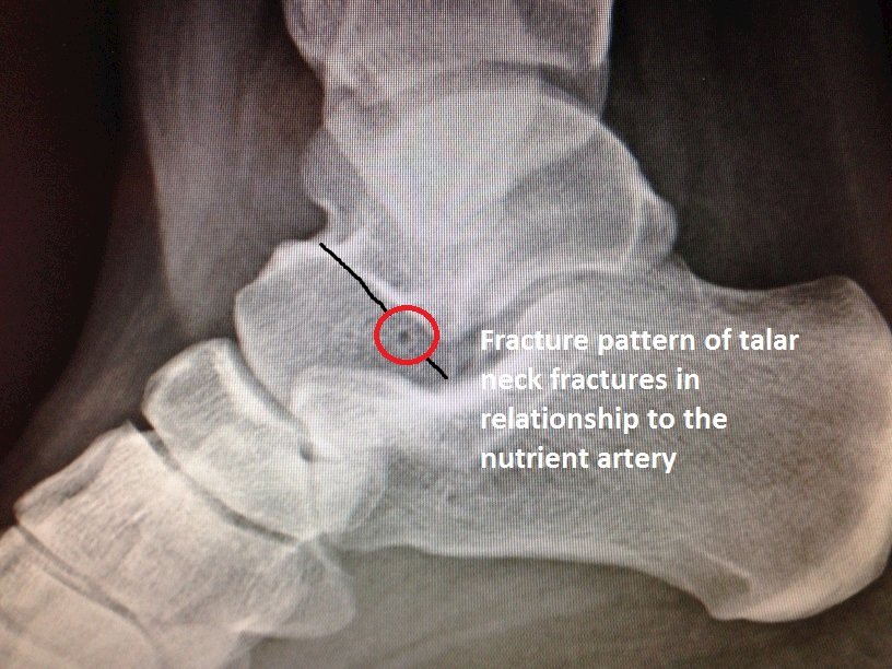 Talus Fracture